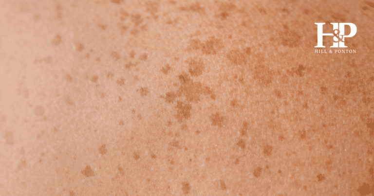 The VA Decision on Hypertension and Agent Orange (PACT Act Update)