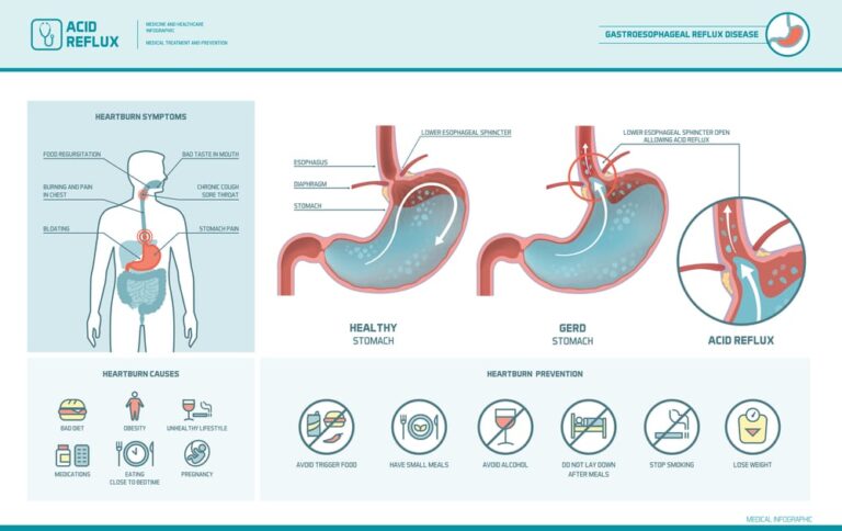VA Secondary Conditions to GERD