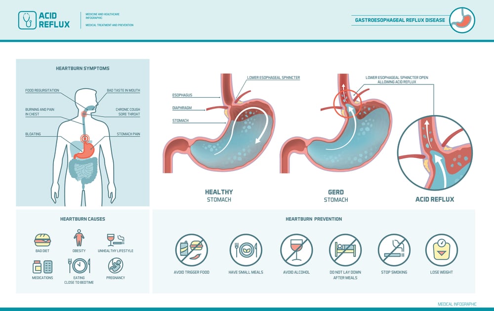 VA Secondary Conditions to GERD