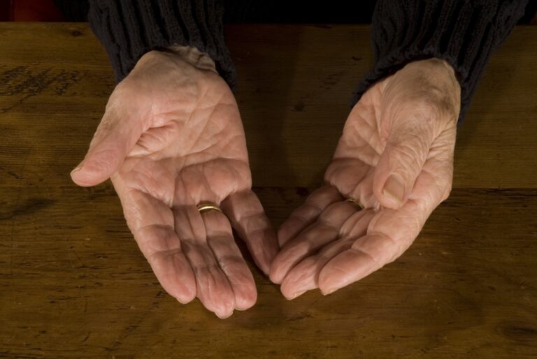Top 3 Questions On Benefits for Loss of Use of Hands | Hill & Ponton, P.A.