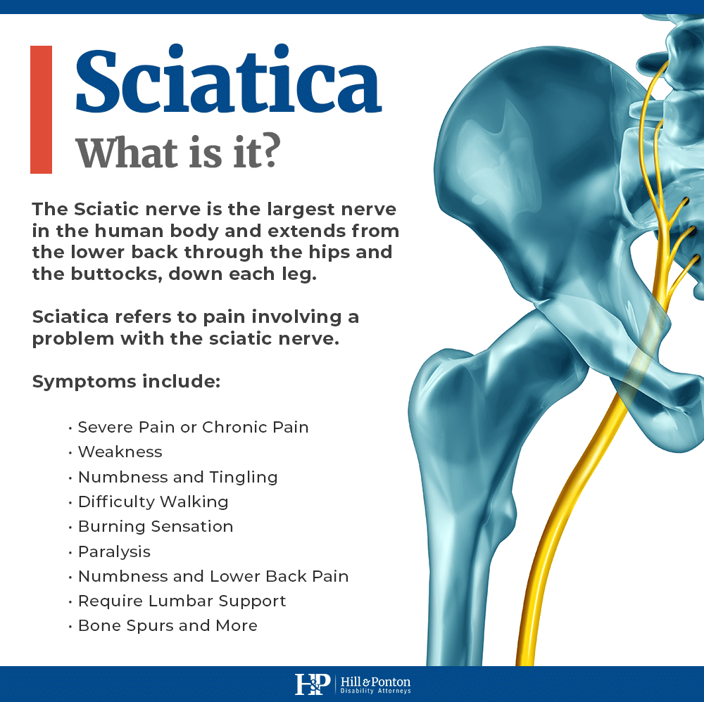 VA Disability Benefits for Sciatica and Similar Nerve Conditions | Hill ...