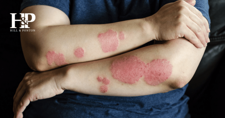 VA Disability for Skin Conditions | Hill & Ponton, P.A.