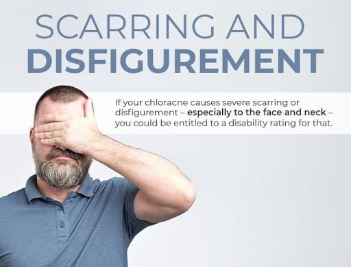 VA Disability Benefits for Chloracne | Hill & Ponton, P.A.