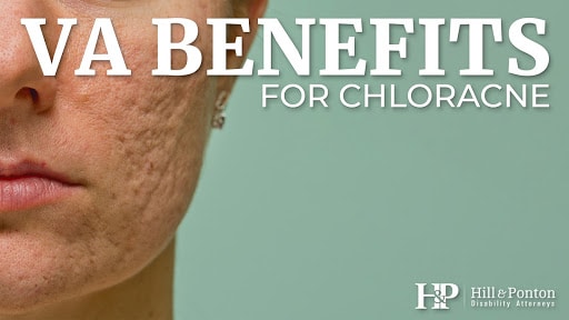 VA Disability Benefits for Chloracne | Hill & Ponton, P.A.