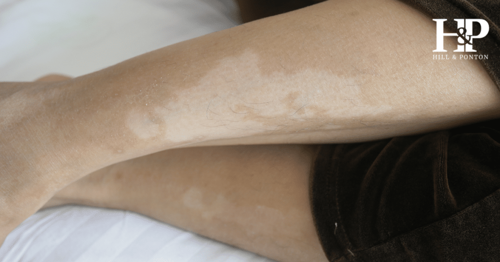VA Disability for Skin Conditions | Hill & Ponton, P.A.